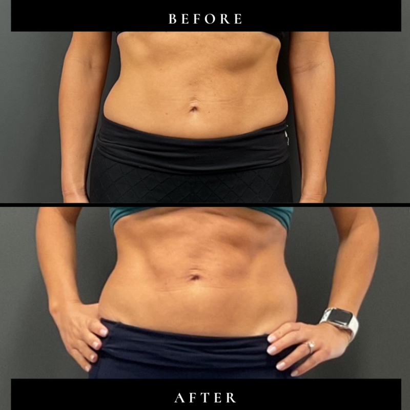 Before & After Archive - La Bella Medical Aesthetics